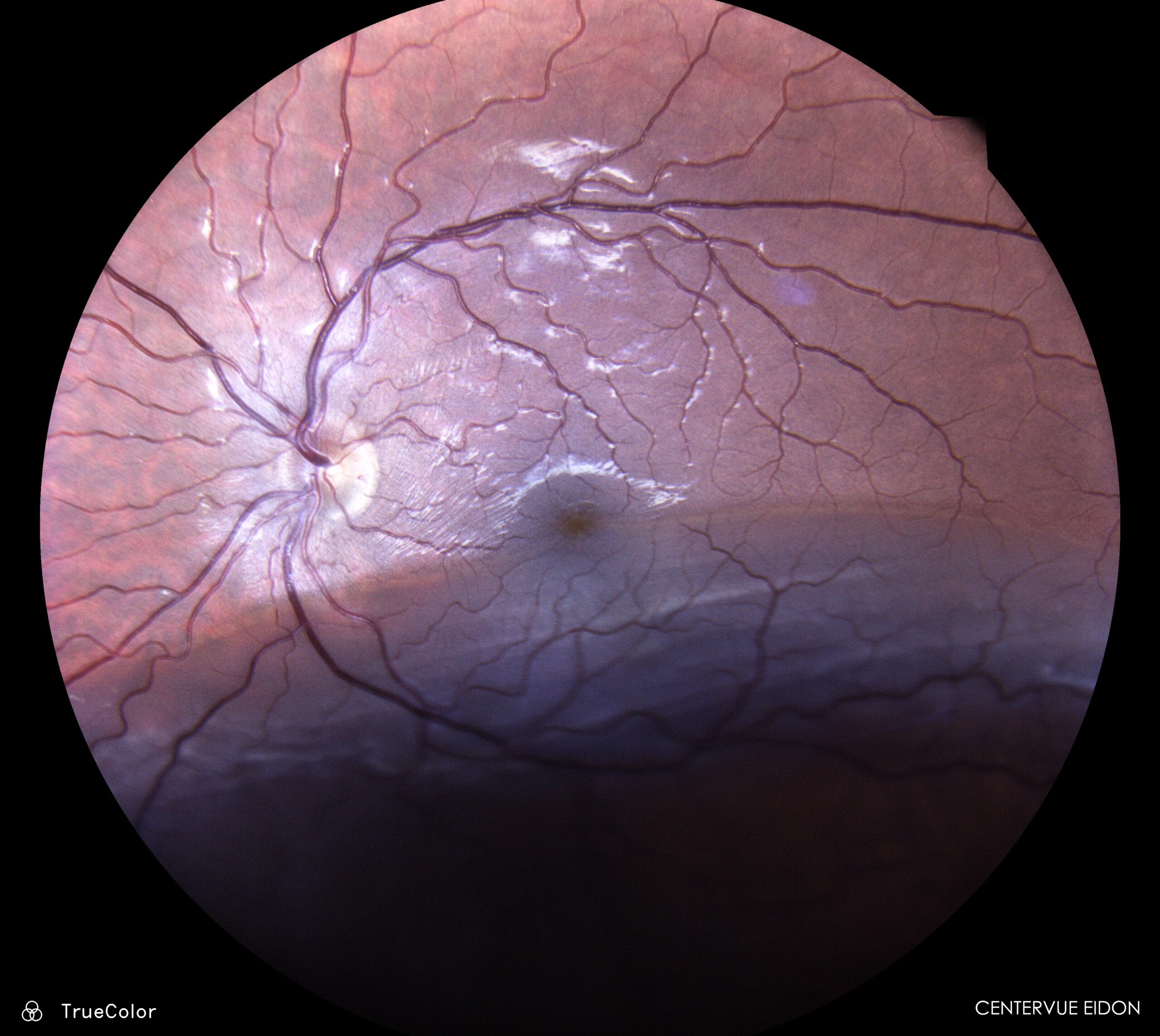 Retinal Detachment after Trauma - West Wichita Family Optometrists