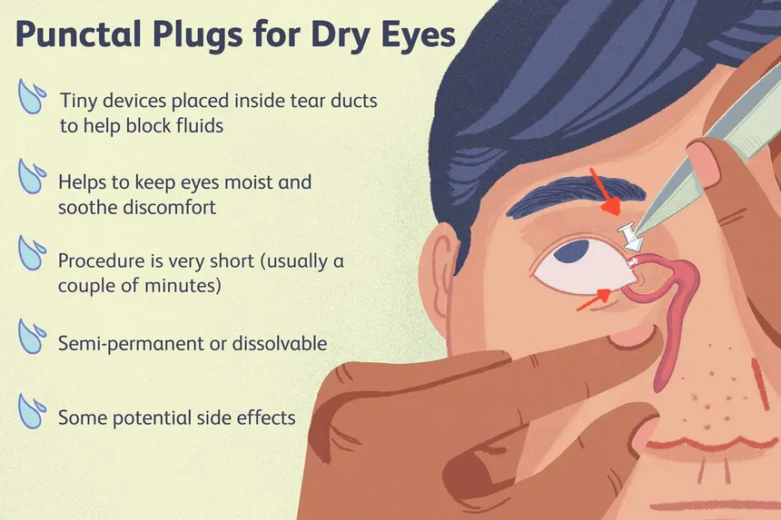 VIDEO - Inserting a Punctal Plug - an in-office Dry Eye Treatment ...